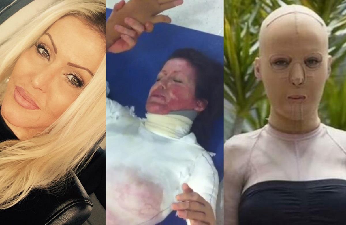 Kako je preživela Srpkinja koju je ljubomorna žena zapalila | Stil