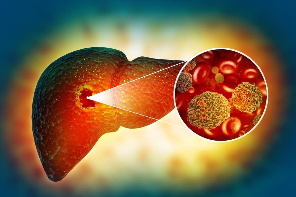 2 najveća krivca za pojavu raka jetre | Stil