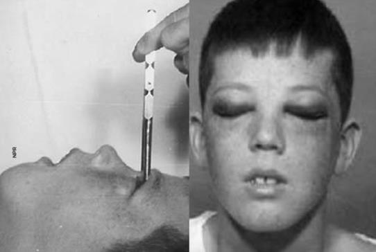 Najmlađi dečak na kome je urađena lobotomija | Stil